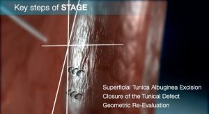 How to Straighten the Penis: 6 Available Treatments