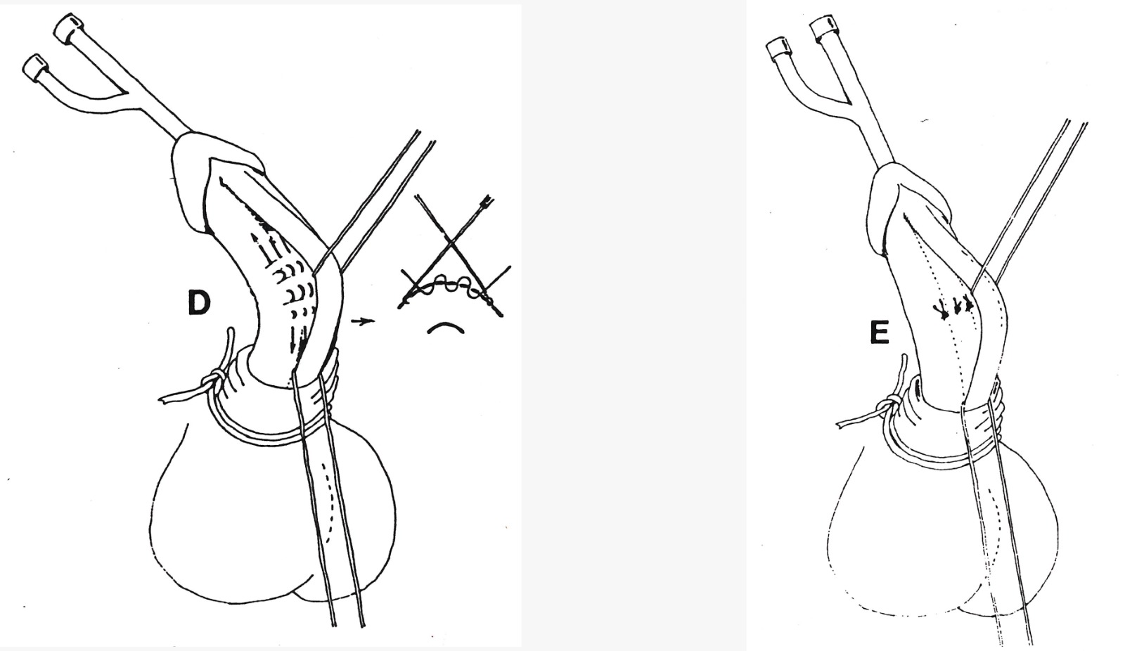 Conheça a Técnica Essed-Schroeder, Yachia e Lue para Curvatura Peniana