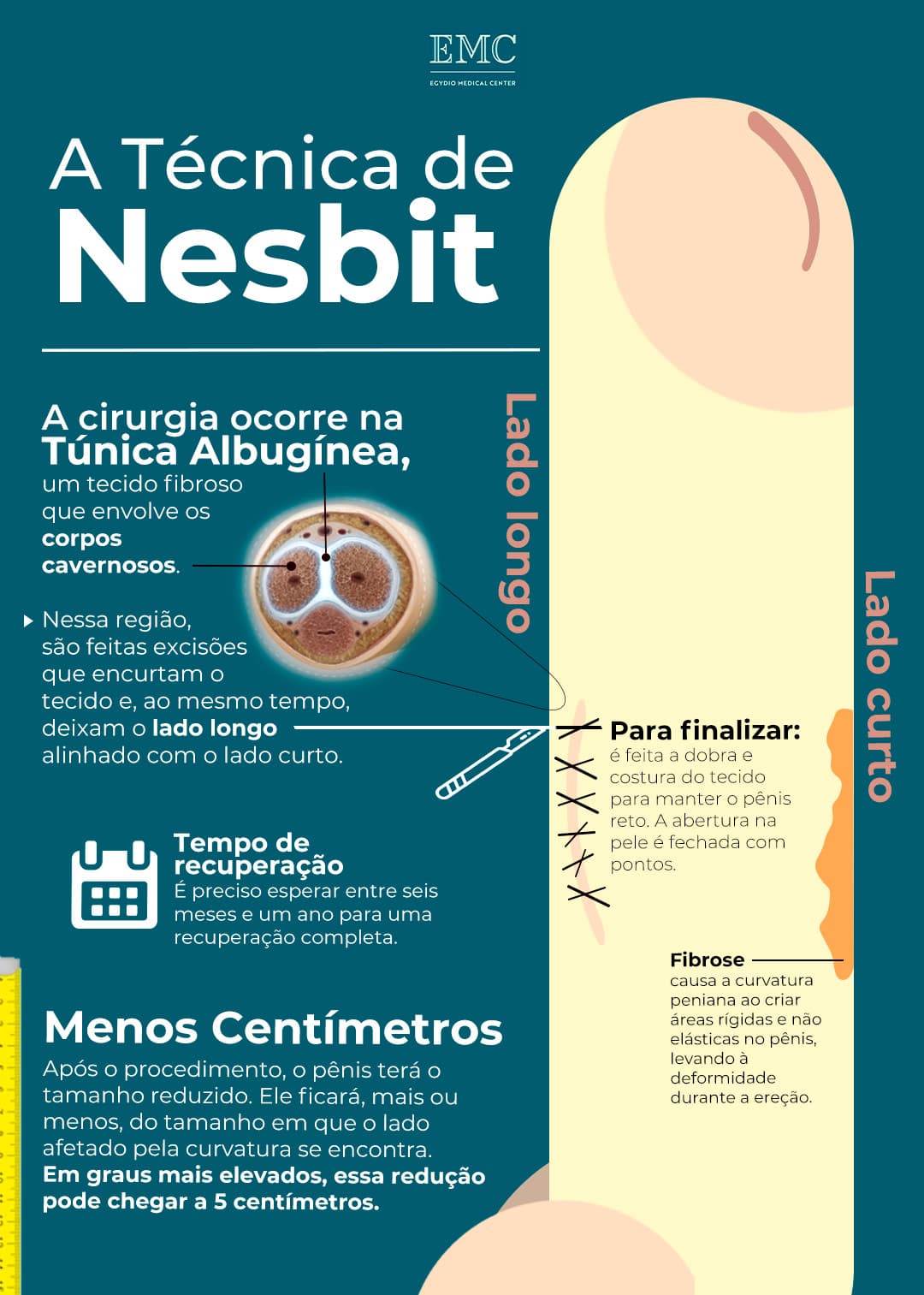 Técnica de Nesbit: O que é e Como a Cirurgia é Feita